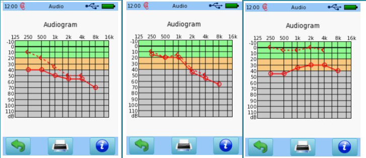 Diagnostics of hearing in children, audiometry, VSWP, impedance ...